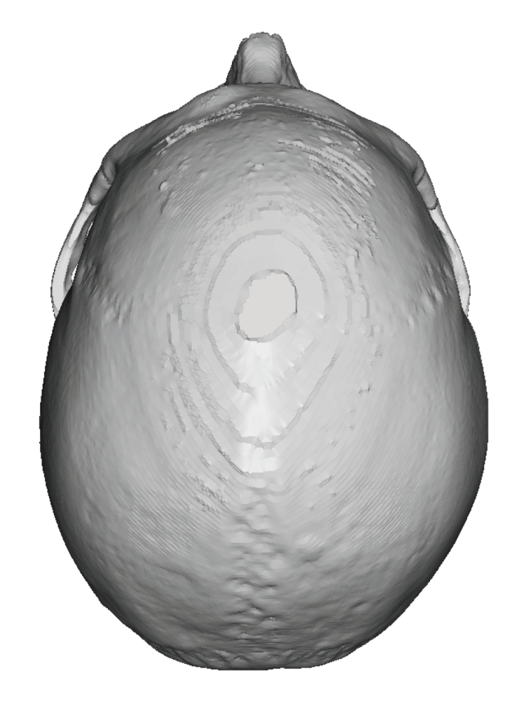 Plastic Surgery Case Study - Custom Skull Implant Augmentation for the ...