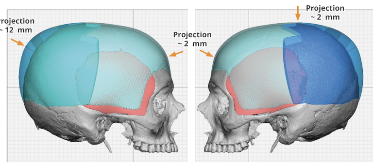 Plastic Surgery Case Study - 1st Stage Scalp Tissue Expansion in Large ...