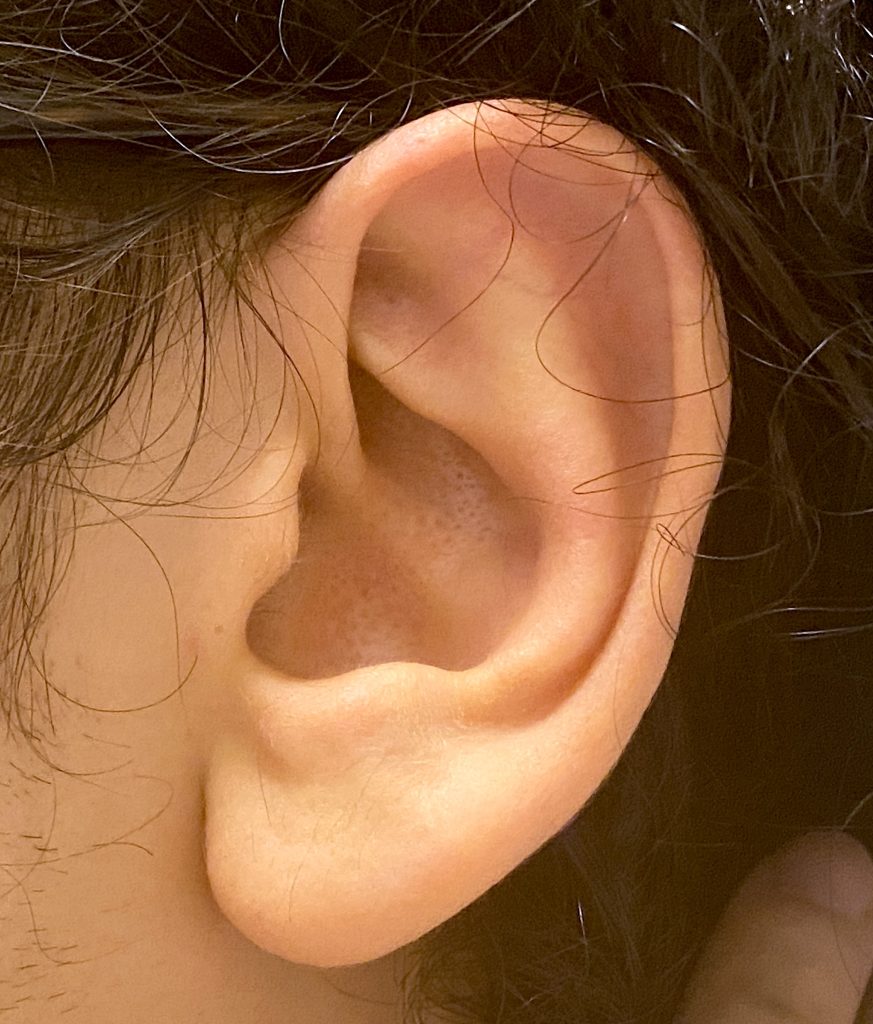 Plastic Surgery Case Study - Major Macrotia Reductions Using a Combined ...