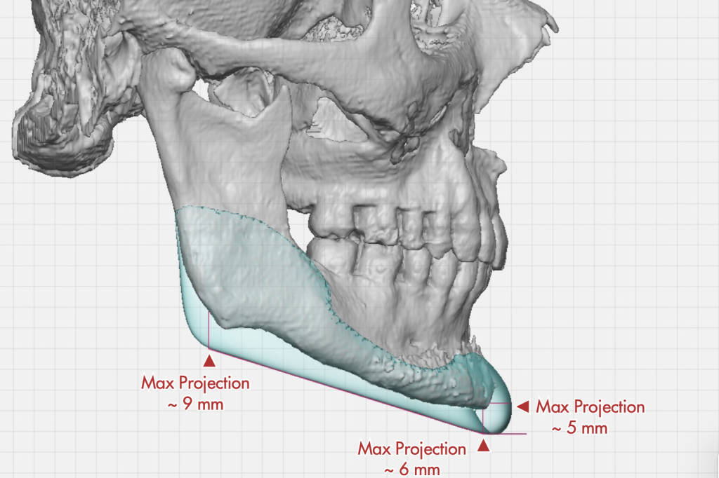 Plastic Surgery Case Study - Custom Jawline Implant Decision Over Bimax ...