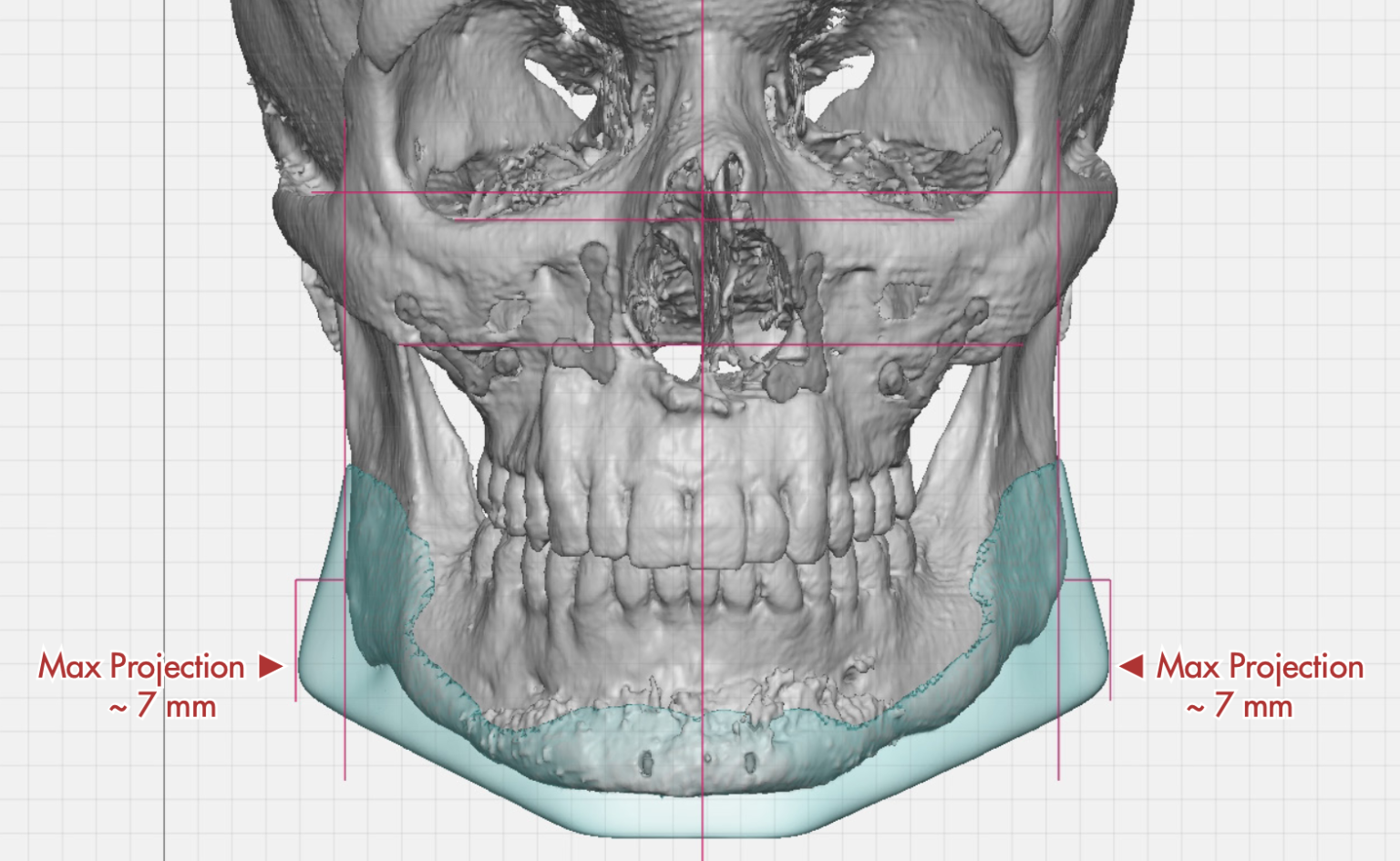 Plastic Surgery Case Study - Custom Jawline Implant Decision Over Bimax ...