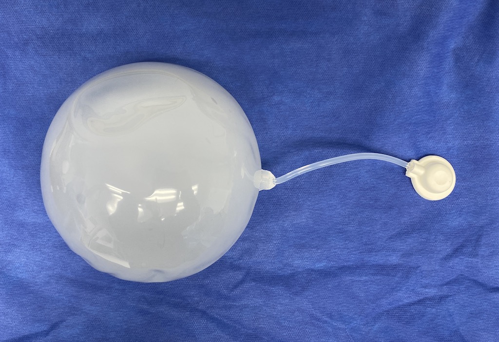 Plastic Surgery Case Study - 1st Stage Scalp Tissue Expansion in Large ...