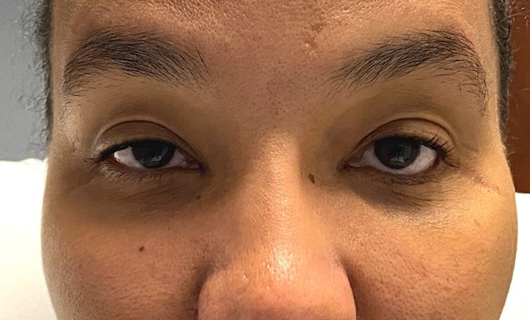 Plastic Surgery Case Study - Improving Scleral Show in the Over ...