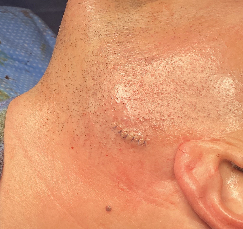 Plastic Surgery Case Study - Secondary Custom Chin and Jaw Angle ...