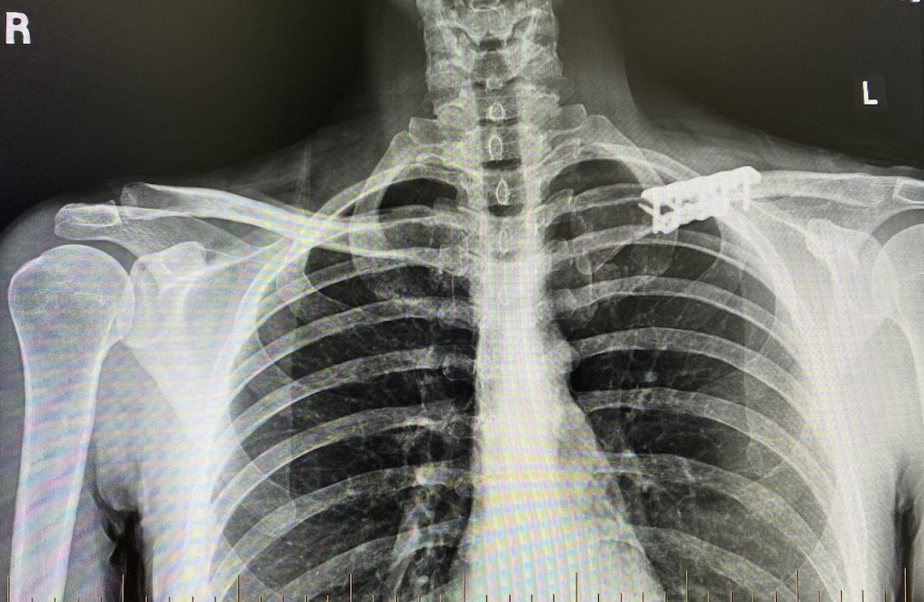 Plastic Surgery Case Study - Staged Shoulder Narrowing by Unilateral ...