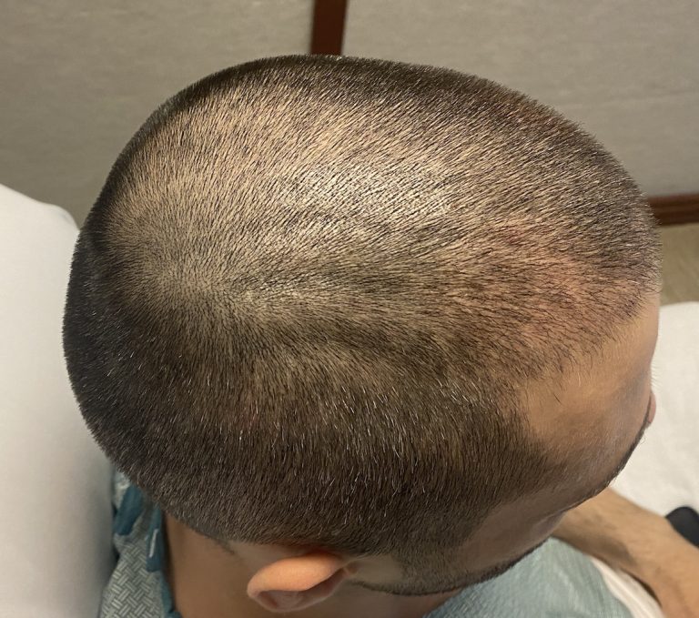 Plastic Surgery Case Study - The Trearment of Scalp Cutis Verticis ...