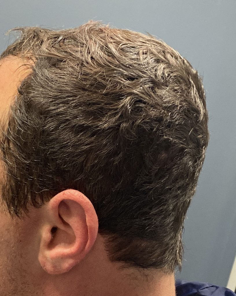 Plastic Surgery Case Study - Custom Skull Implant Augmentation for the ...