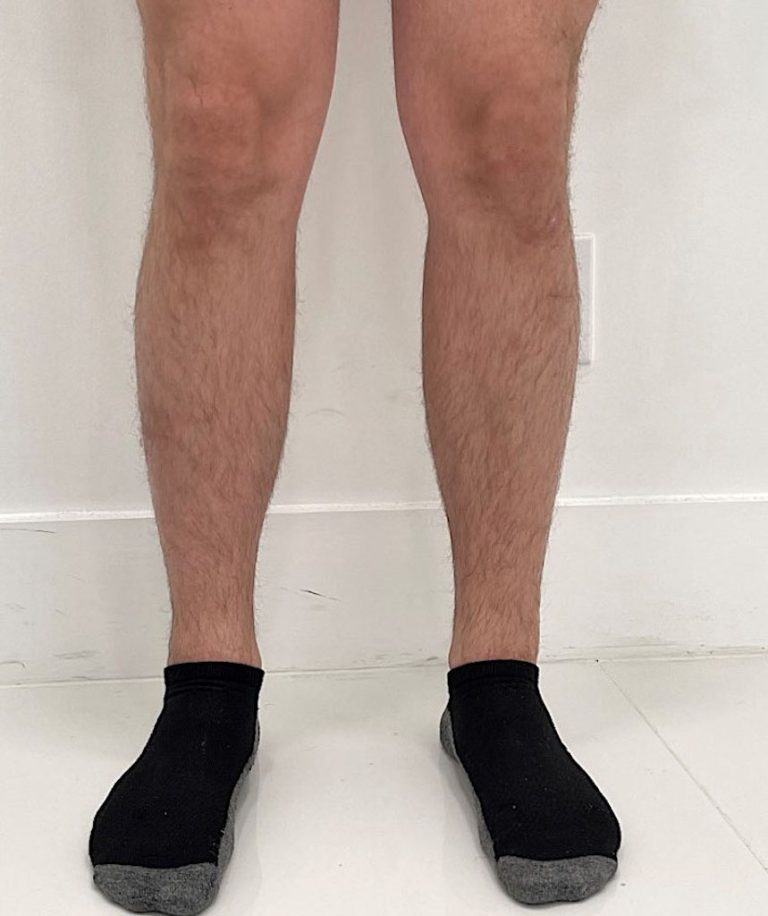 Plastic Surgery Case Study - The Four Calf Implant Approach for ...