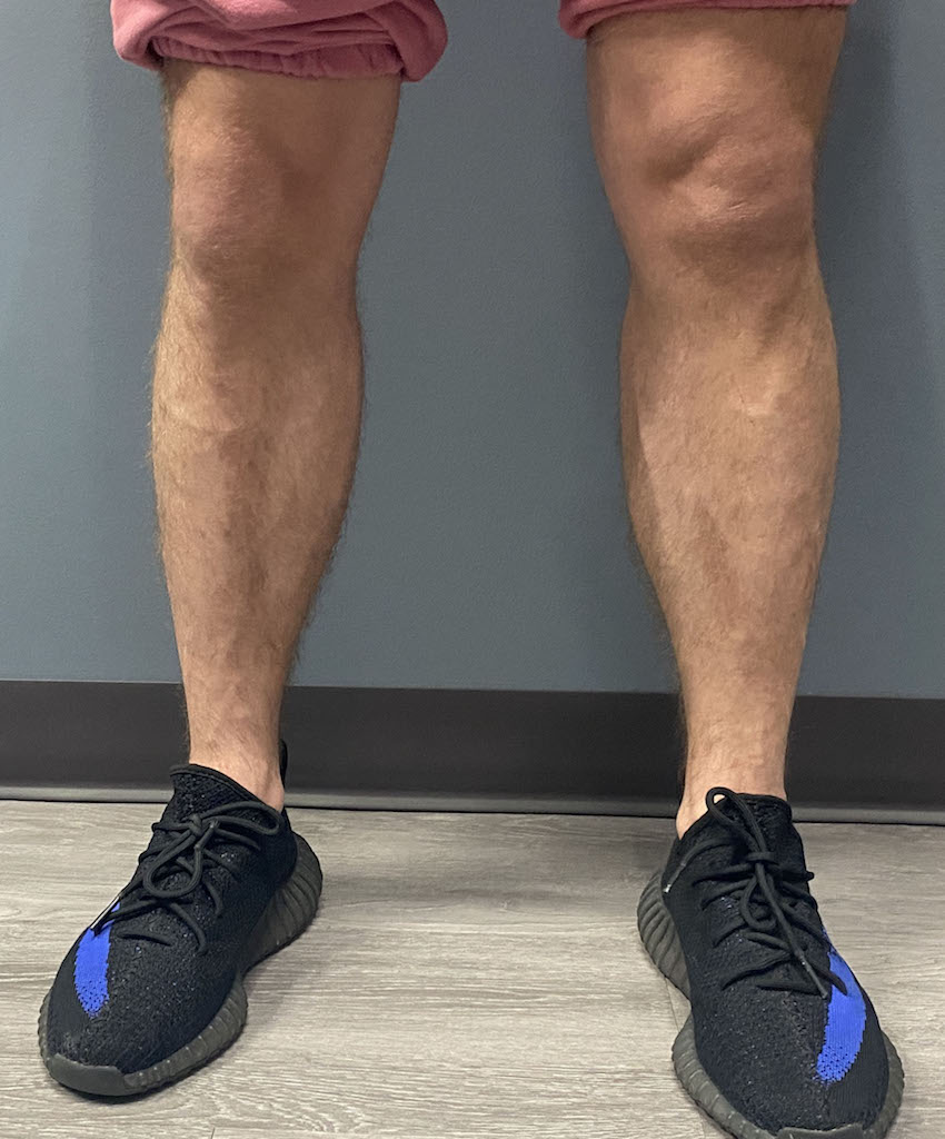 Plastic Surgery Case Study - The Four Calf Implant Approach for ...