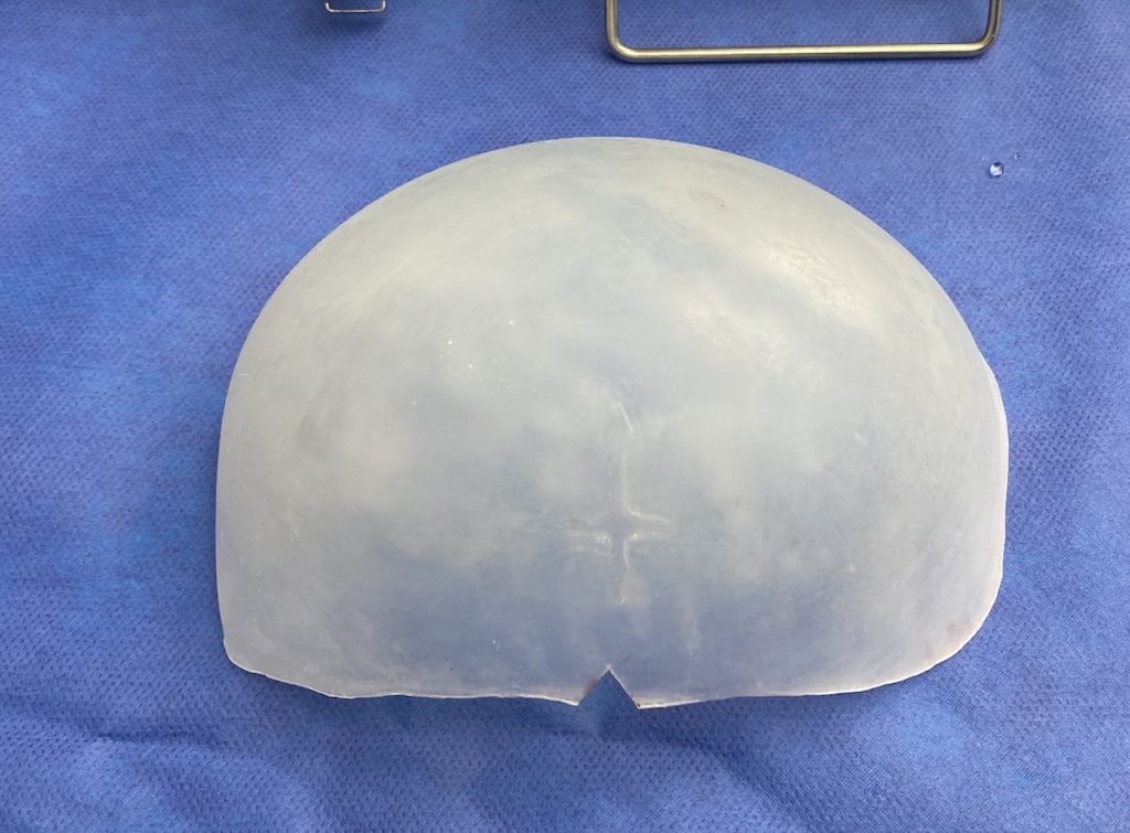 Plastic Surgery Case Study - Custom Skull Implant Augmentation for the ...