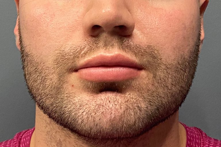 Plastic Surgery Case Study - Custom Jawline Implant Replacement For A ...