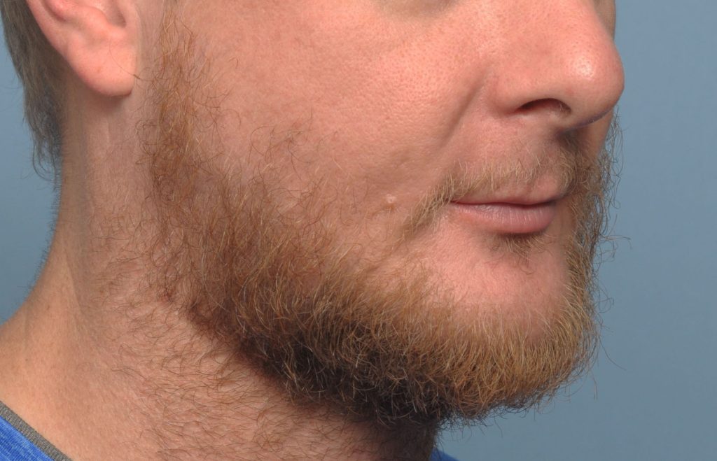 Plastic Surgery Case Study - Custom Jawline Implant Decision Over Bimax ...