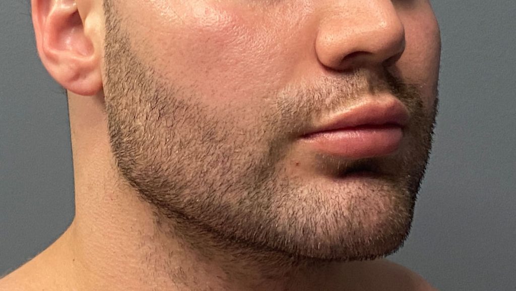 Plastic Surgery Case Study - Custom Jawline Implant Replacement For A ...