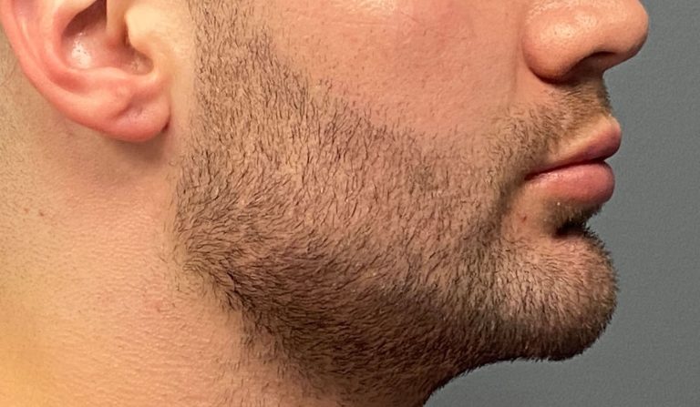 Plastic Surgery Case Study - Custom Jawline Implant Replacement For A ...