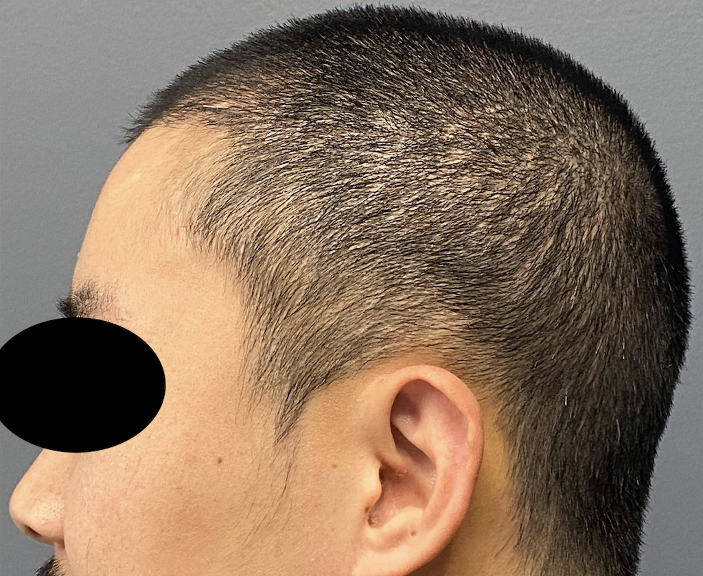 Plastic Surgery Case Study - The Aesthetic Advantages of a Custom Skull ...