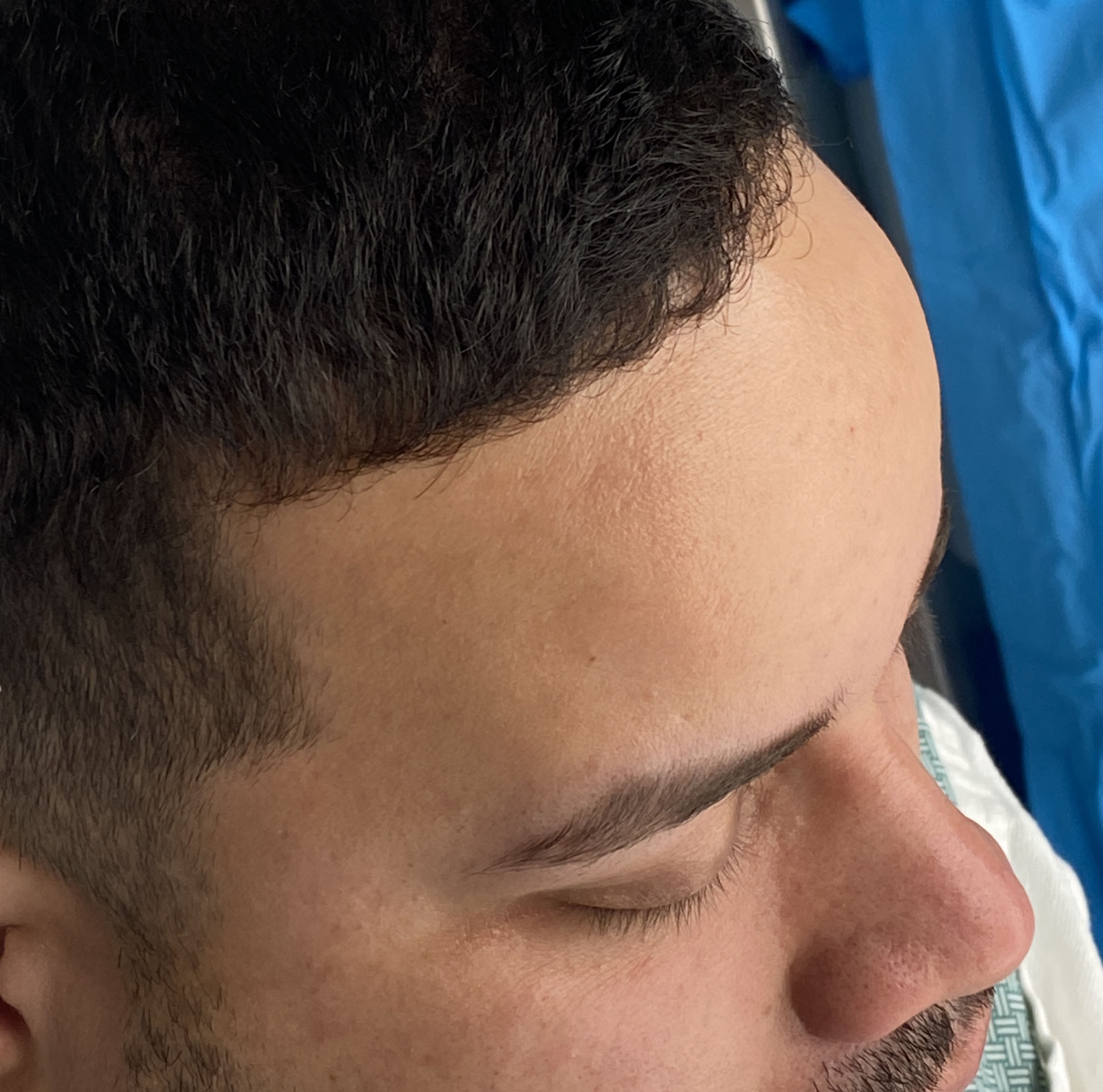 male forehead reduction right oblique 1 Dr Barry Eppley - Explore ...