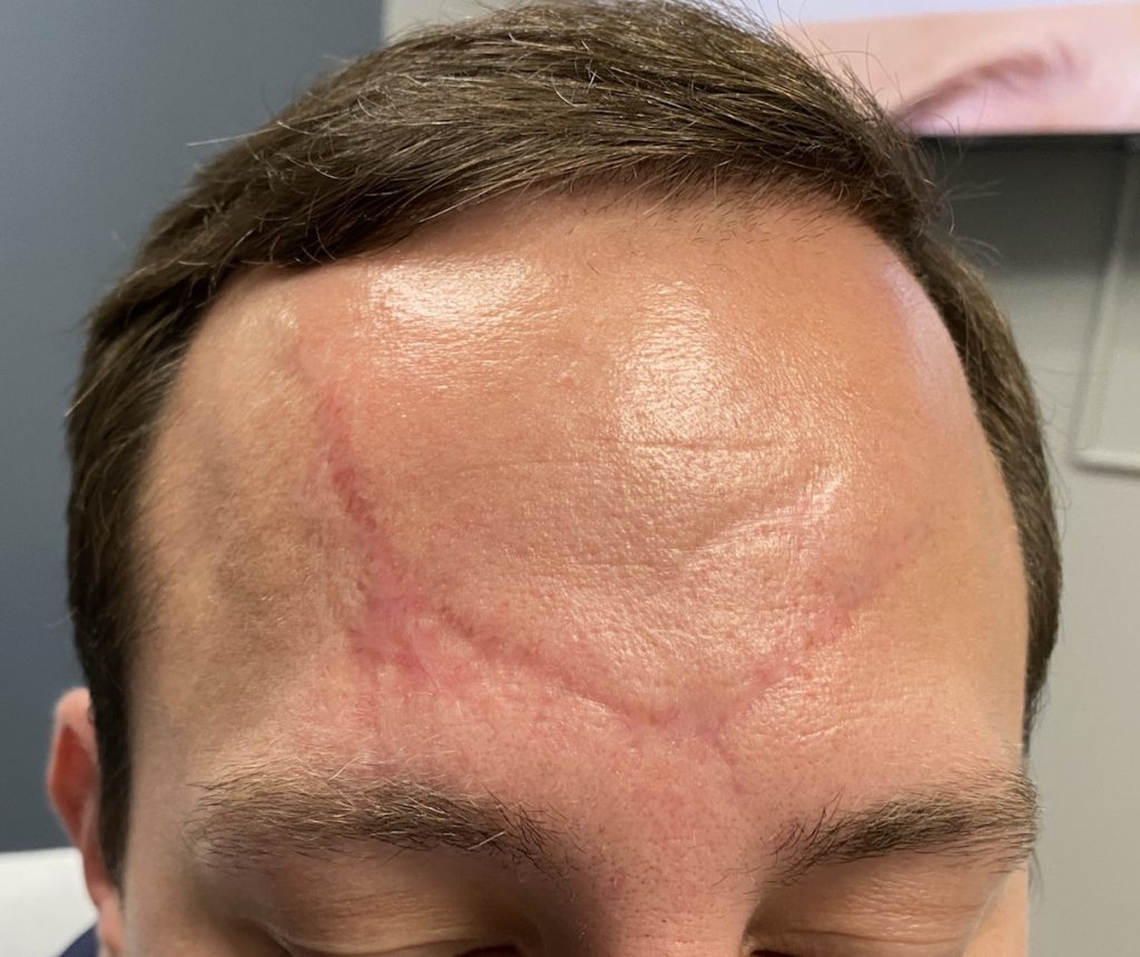 Plastic Surgery Case Study - Geometic Scar Revision of a Traumatic ...