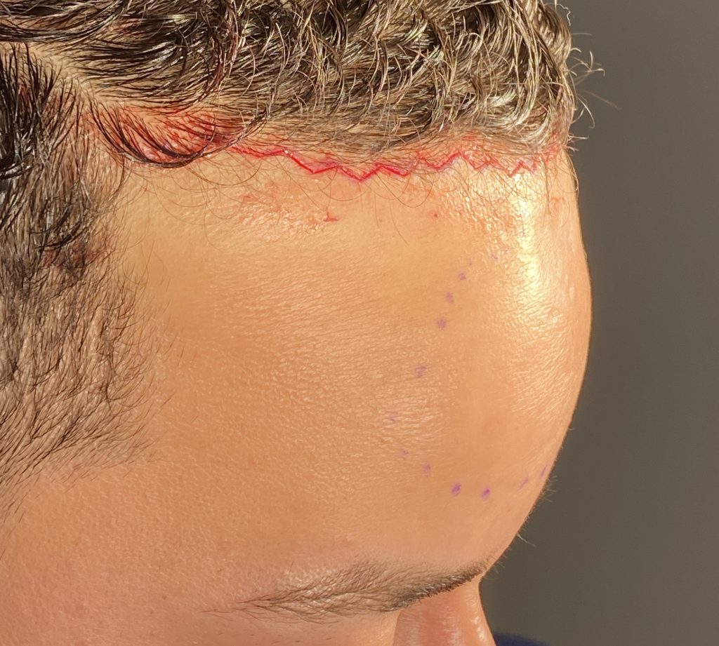 male frontal hairline incision side view Dr Barry Eppley - Explore ...
