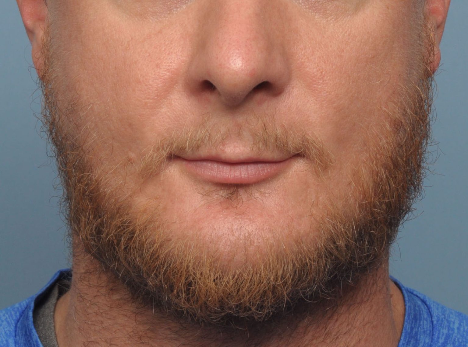 Plastic Surgery Case Study - Custom Jawline Implant Decision Over Bimax ...