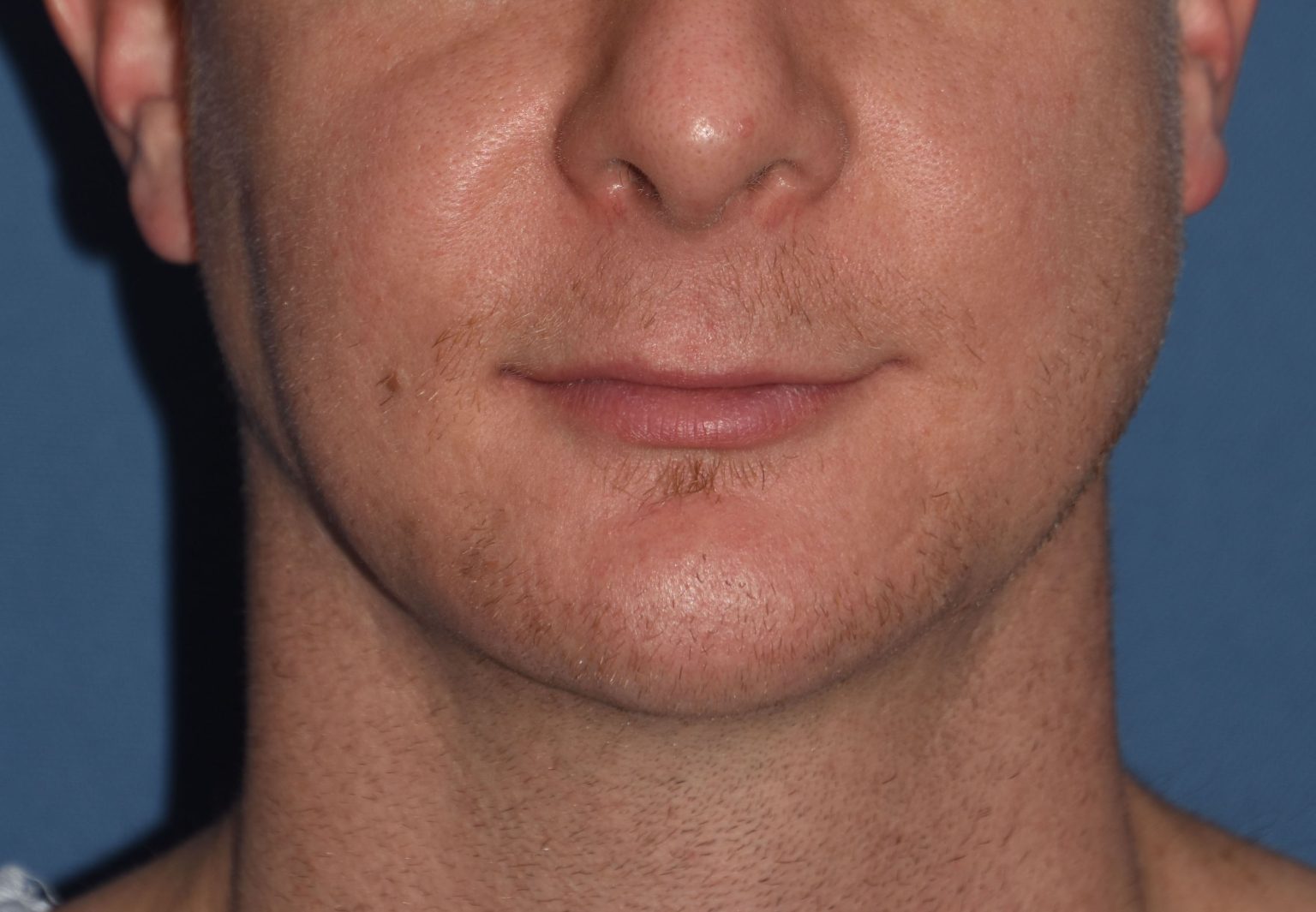 Plastic Surgery Case Study - Custom Jawline Implant Decision Over Bimax ...