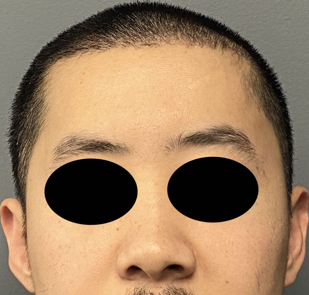 Plastic Surgery Case Study - The Aesthetic Advantages of a Custom Skull ...