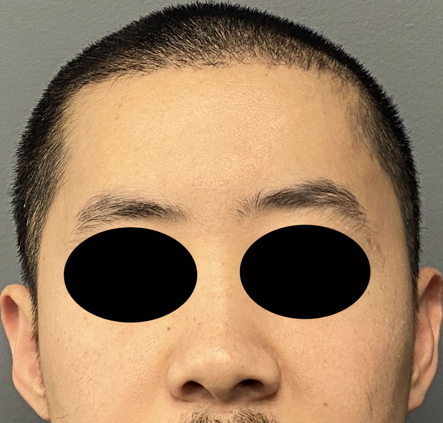 Plastic Surgery Case Study - The Aesthetic Advantages of a Custom Skull ...