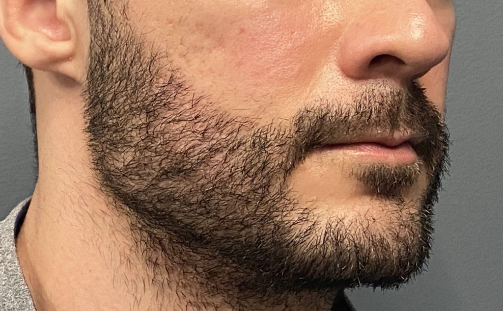 male square bjawline implant oblique 2 Dr Barry Eppley - Explore ...