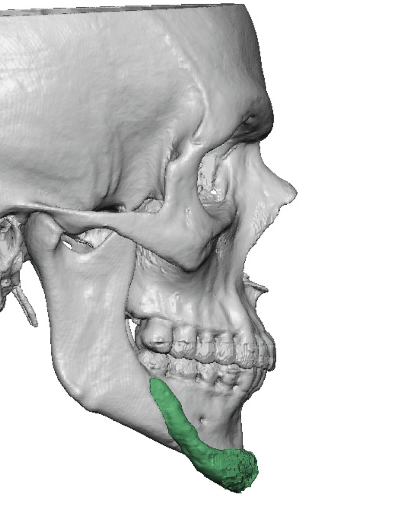 Plastic Surgery Case Study - Custom Jawline Implant Replacement For A ...