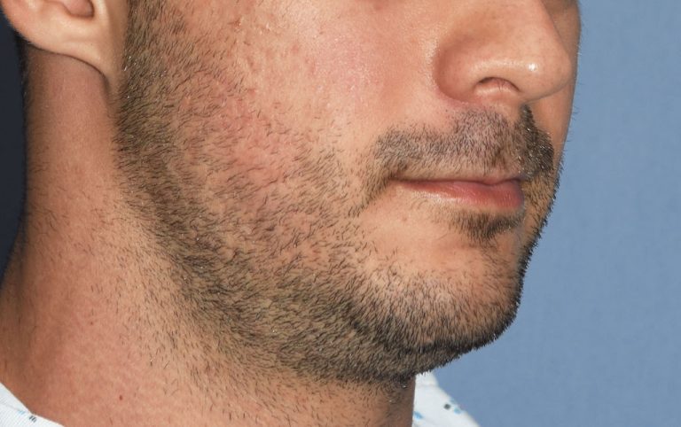 male square jawline implant oblique 1 Dr Barry Eppley - Explore Plastic ...