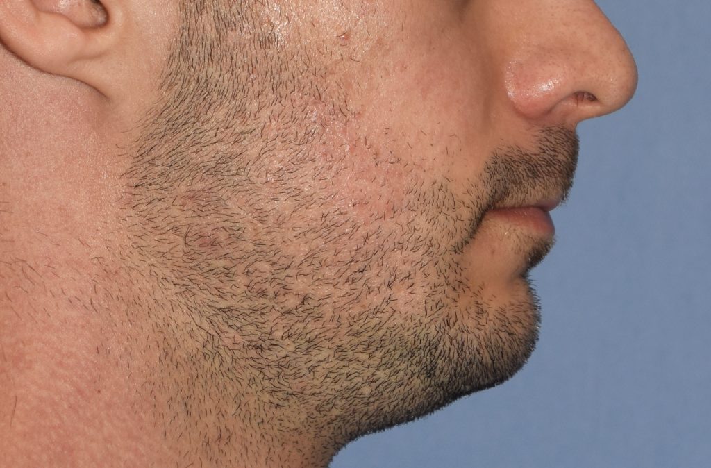 male square jawline implant side 1 Dr Barry Eppley - Explore Plastic ...