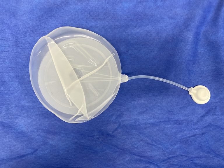 Plastic Surgery Case Study - 1st Stage Scalp Tissue Expansion in Large ...