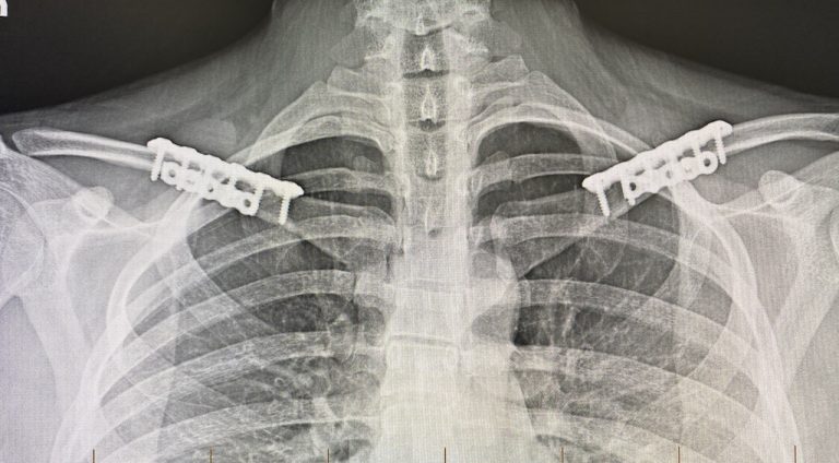 Plastic Surgery Case Study - Clavicle Bone Alignment and Apposition in ...