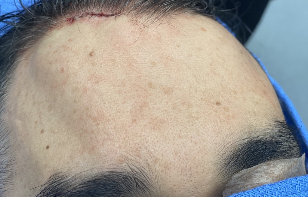 Technical Strategies - Single Incision Endoscopic Removal of Benign ...