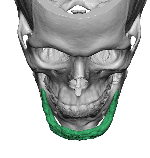 Plastic Surgery Case Study - Custom Jawline Implant Replacement For A ...