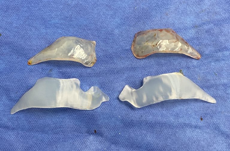 Plastic Surgery Case Study - Increasing Midface Projection and Lift ...