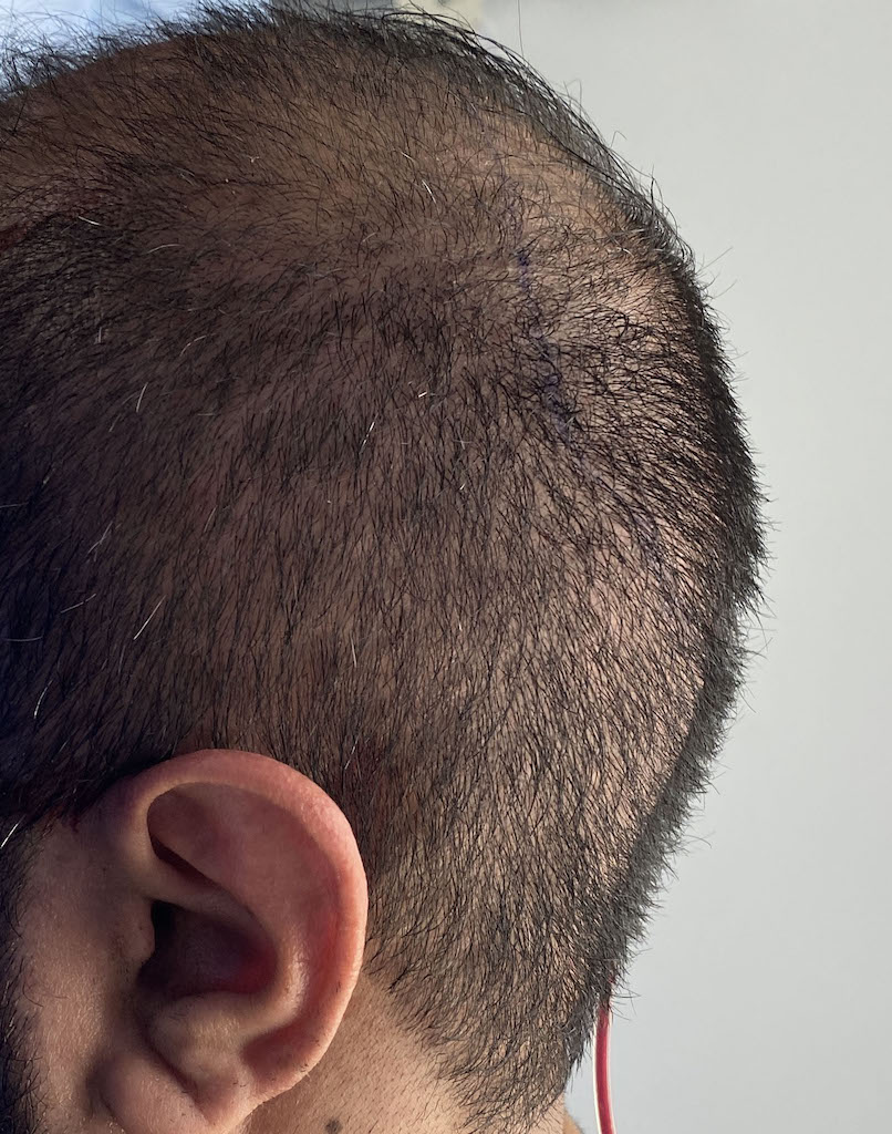 Plastic Surgery Case Study - Custom Skull Implant Correction for ...