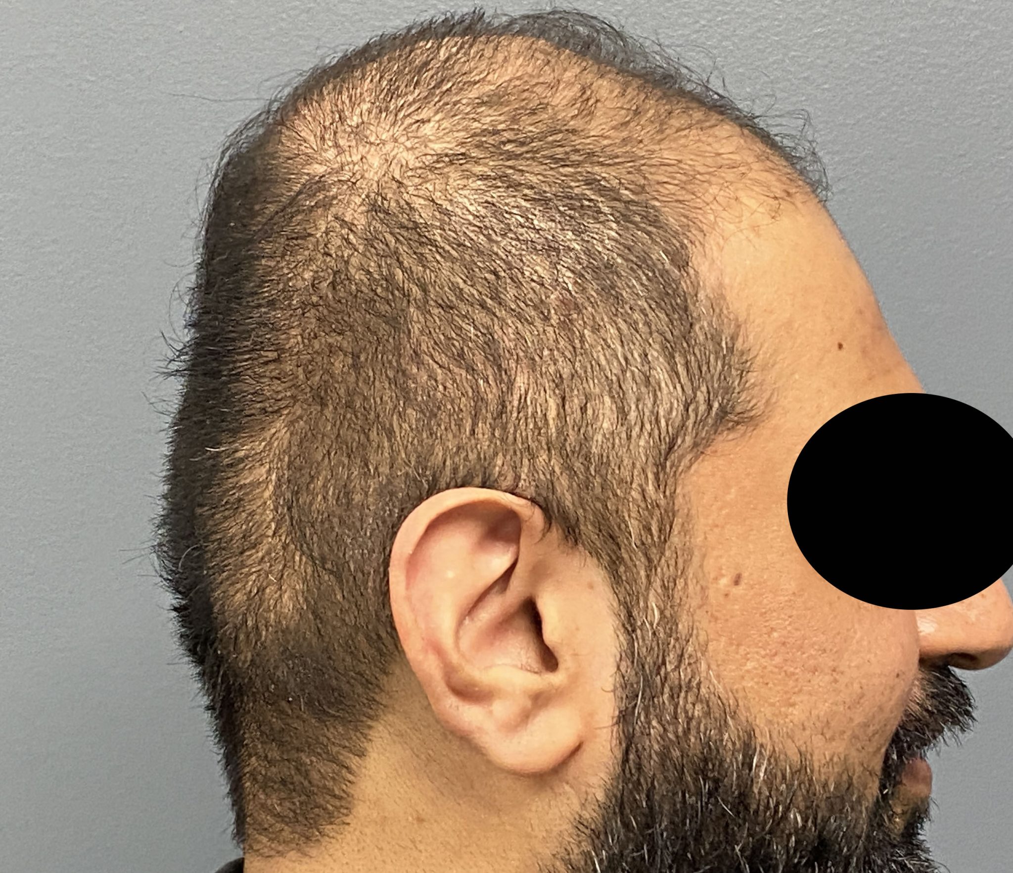 Plastic Surgery Case Study - Custom Skull Implant Correction for ...