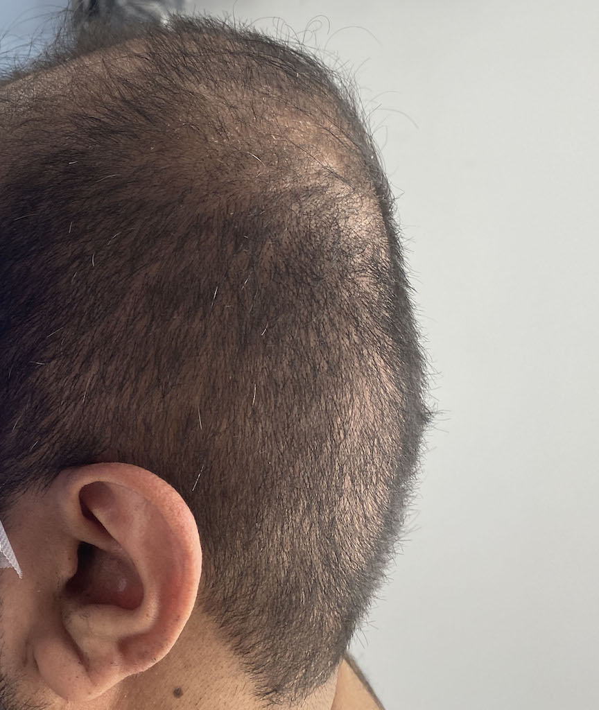 Plastic Surgery Case Study - Custom Skull Implant Correction for ...