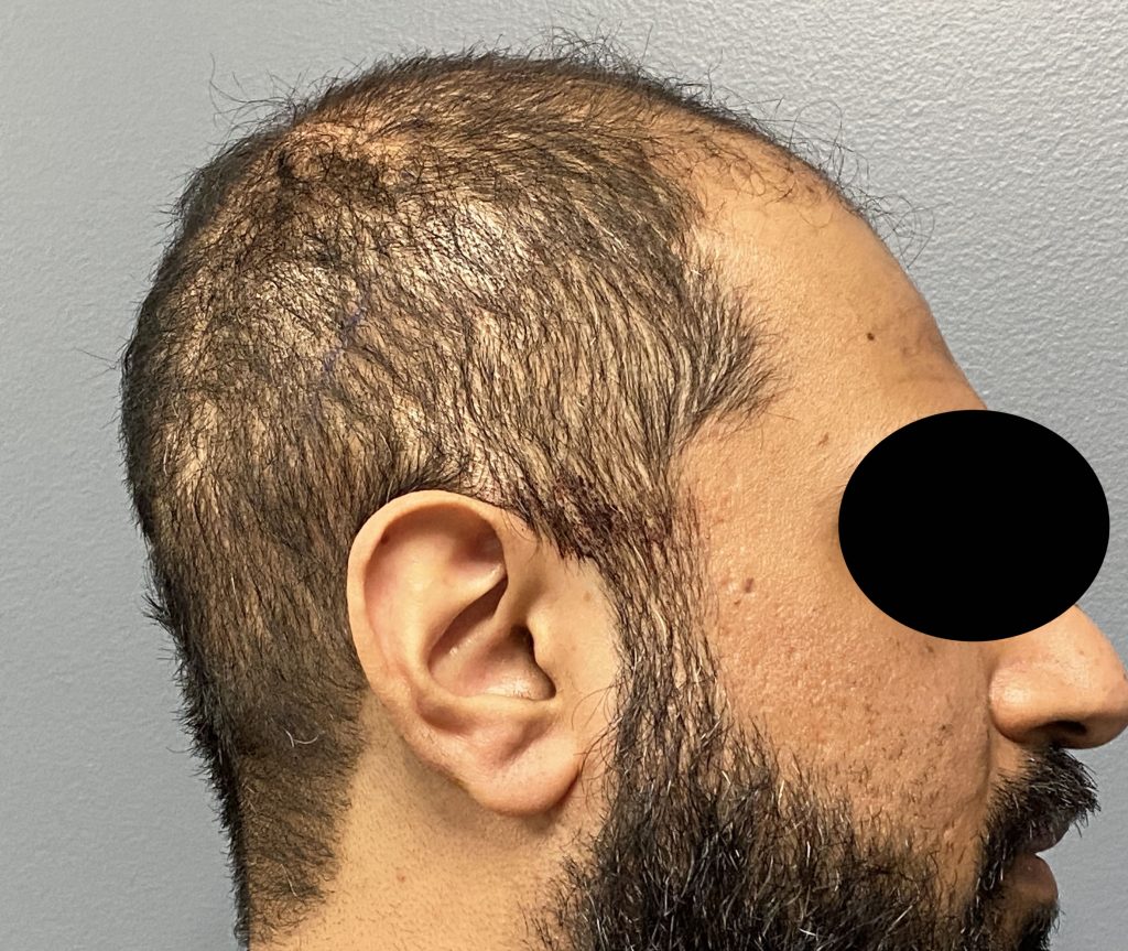 Plastic Surgery Case Study - Custom Skull Implant Correction for ...