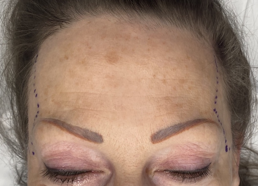 Technical Strategies - The High Retro Hairline Incision for Extended ...