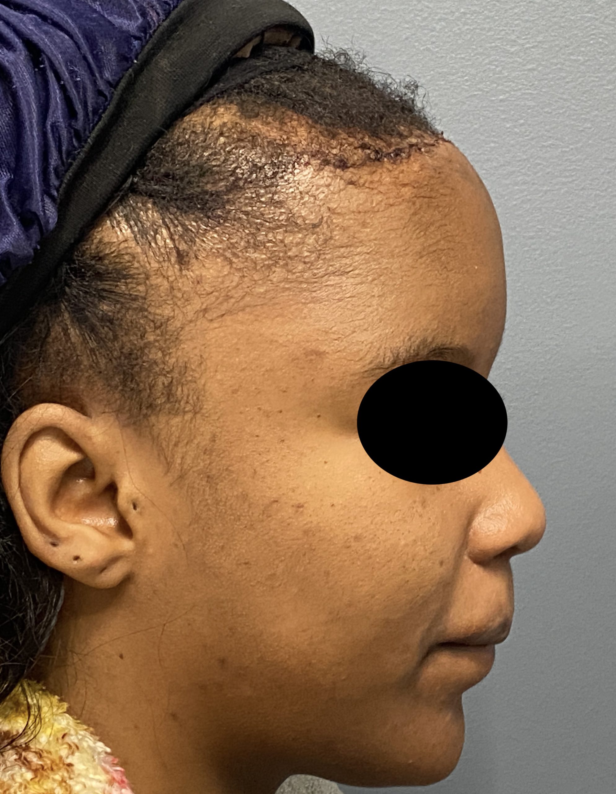 Plastic Surgery Case Study - Female Forehead Bossing Reduction Combined ...