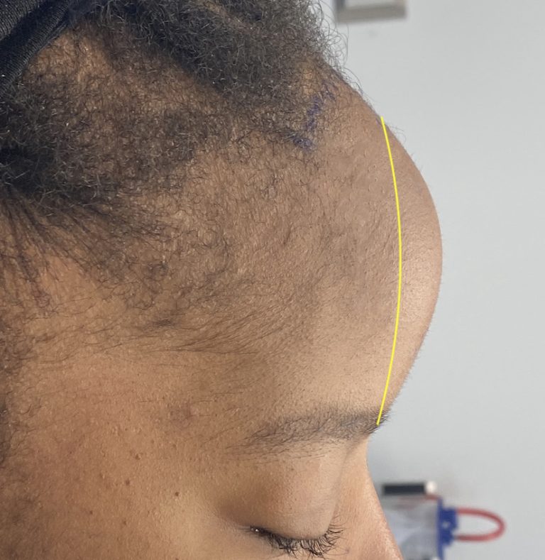 Plastic Surgery Case Study - Female Forehead Bossing Reduction Combined ...