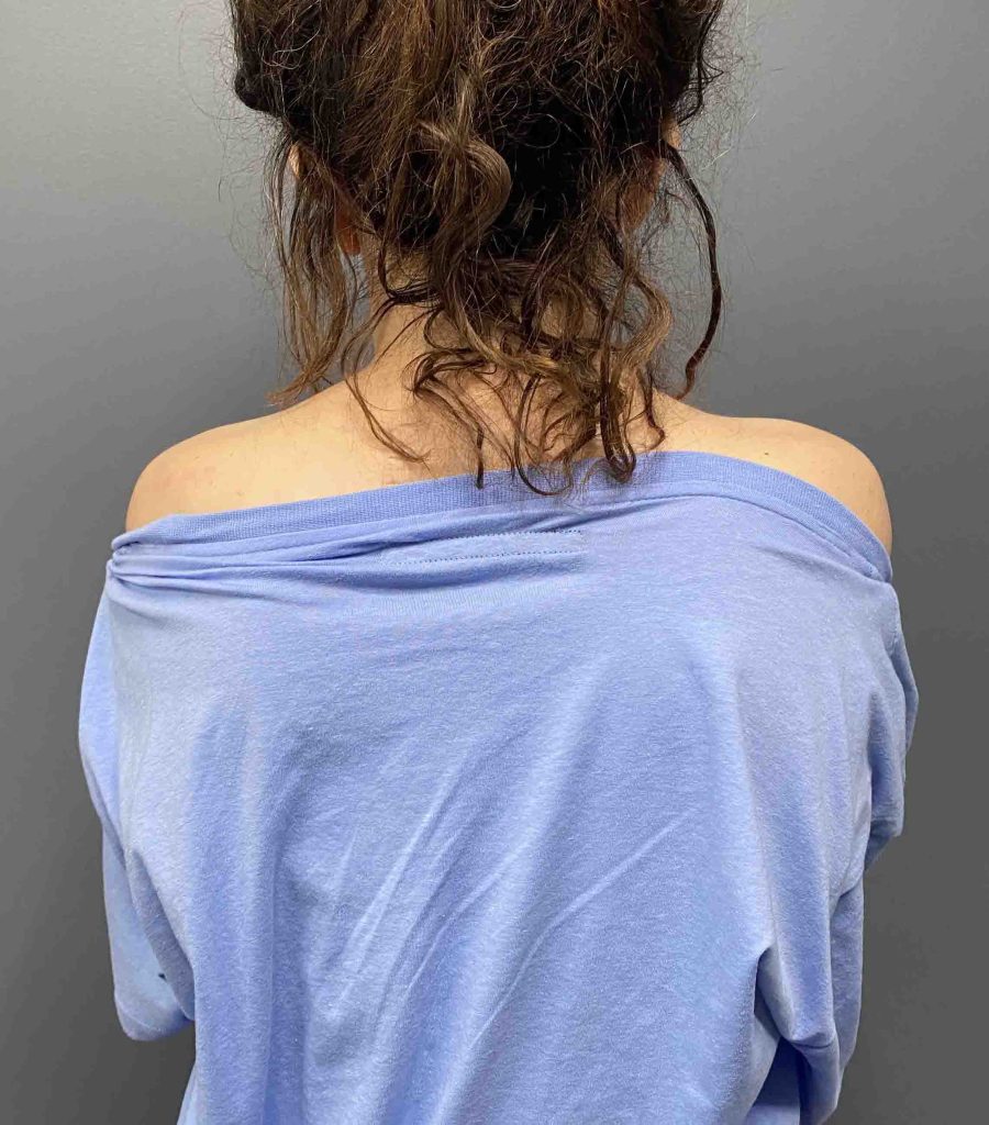 Plastic Surgery Case Study - Clavicle Reduction Osteotomies (Shoulder ...