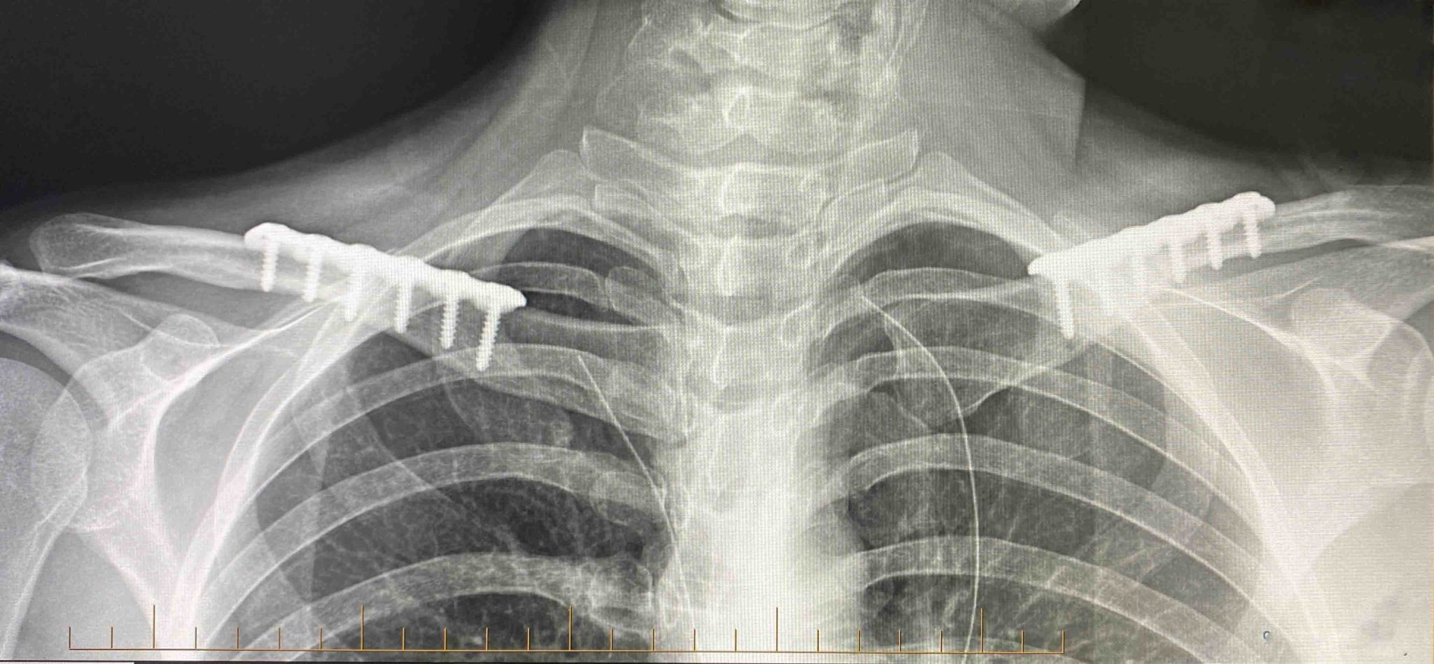 Plastic Surgery Case Study - Clavicle Reduction Osteotomies (Shoulder ...