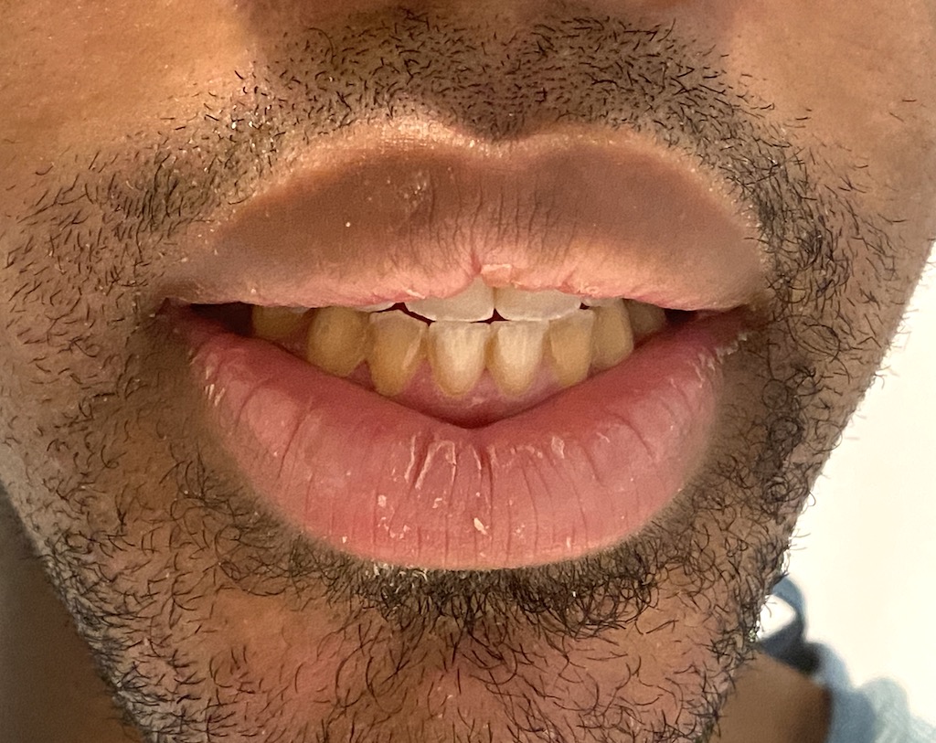 Plastic Surgery Case Study - Treatment of the Contracted Lower Lip ...