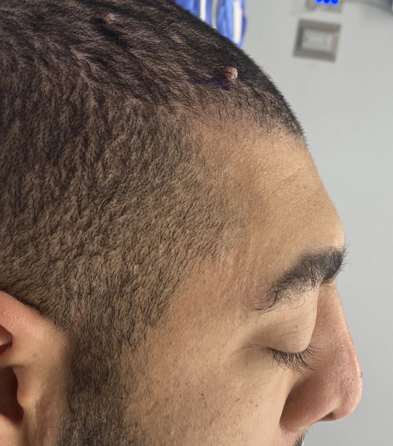 Plastic Surgery Case Study - Male Forehead Reshaping with Combined Brow ...