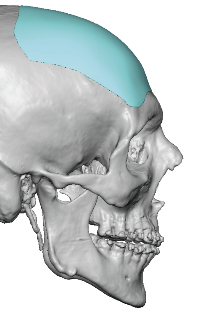 Plastic Surgery Case Study - Male Forehead Reshaping with Combined Brow ...