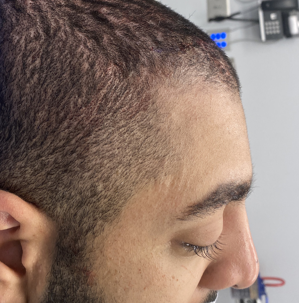 Plastic Surgery Case Study - Male Forehead Reshaping with Combined Brow ...