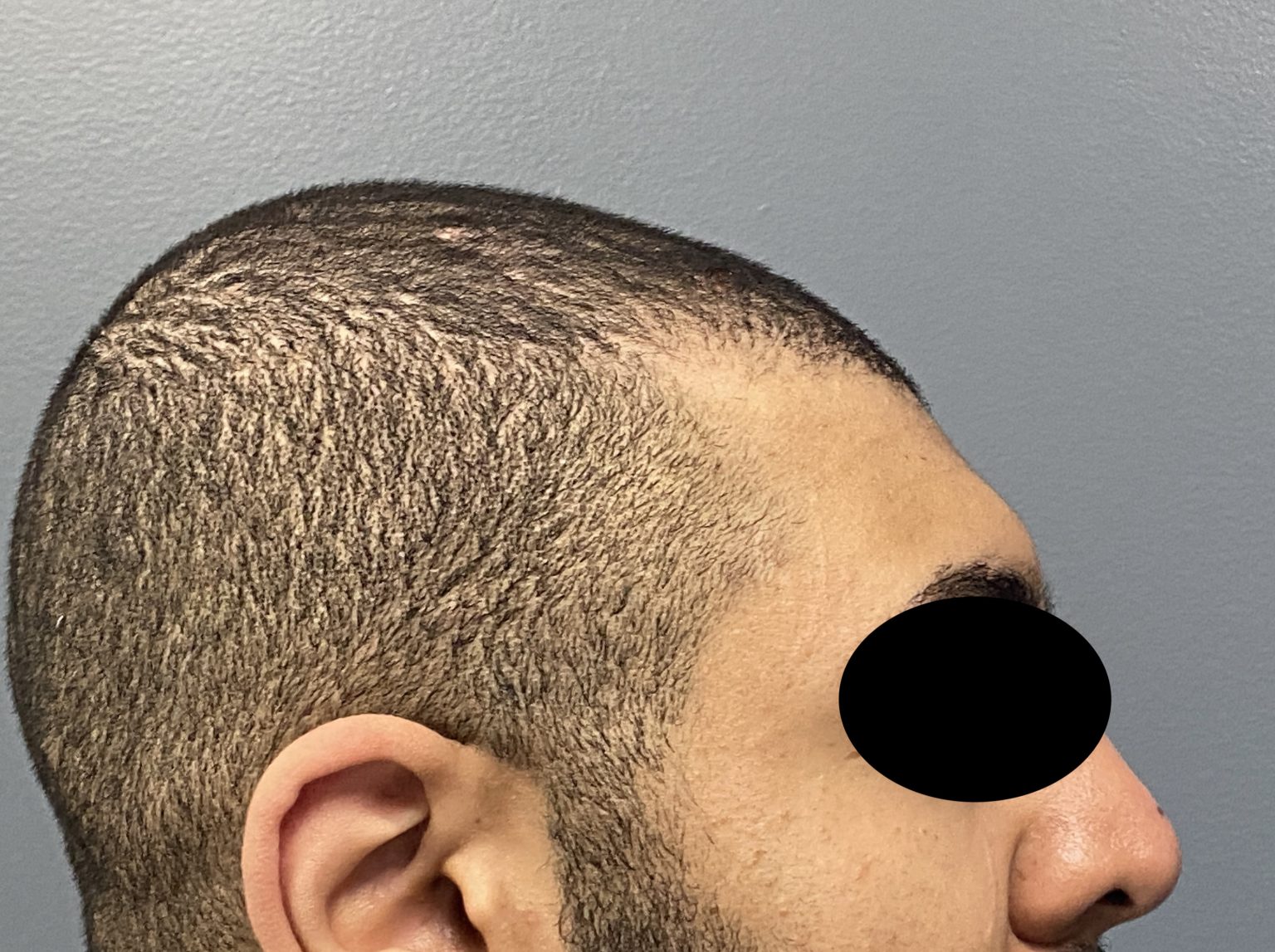 Plastic Surgery Case Study - Male Forehead Reshaping with Combined Brow ...