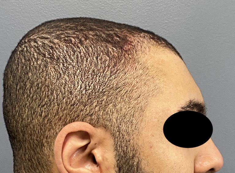 Plastic Surgery Case Study - Male Forehead Reshaping with Combined Brow ...